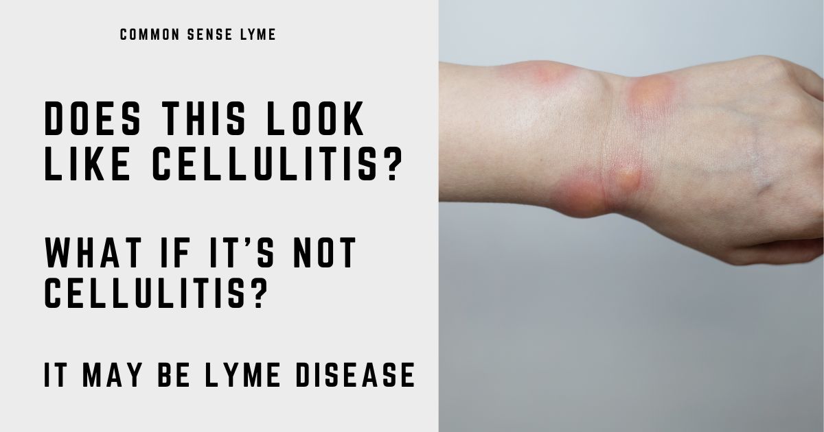 Is It Cellulitis or Lyme Disease? Rash Differences Explained